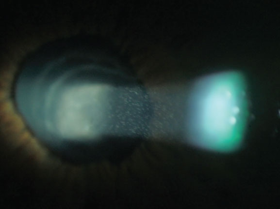 Assessing the Anterior Chamber